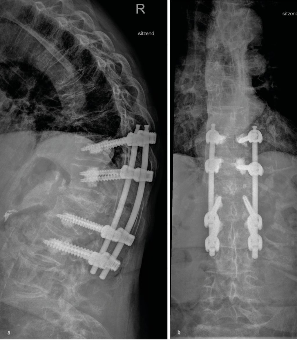 Osteoporotische Frakturen der thorakalen und lumbalen Wirbelsäule - Orthopädie & Traumatologie ...